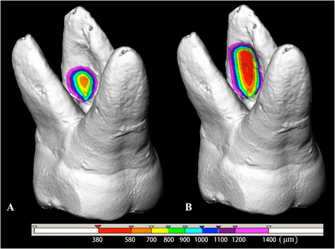 The remaining dentin thickness investigation of the attempt to remove ...