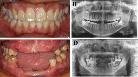 Dentin dysplasia type I—novel findings in deciduous and permanent teeth ...