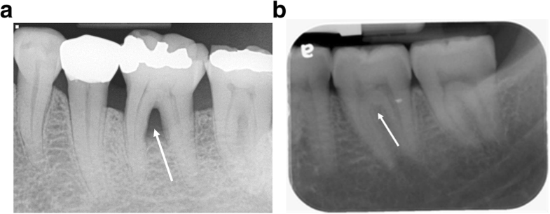 A retrospective study on molar furcation assessment via clinical ...