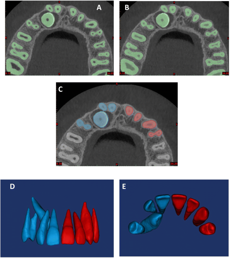 Morphology of palatally displaced canines and adjacent teeth, a 3-D ...