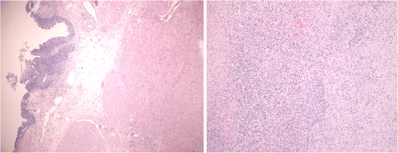 Delayed diagnosis of spontaneous bladder rupture: a rare case report ...