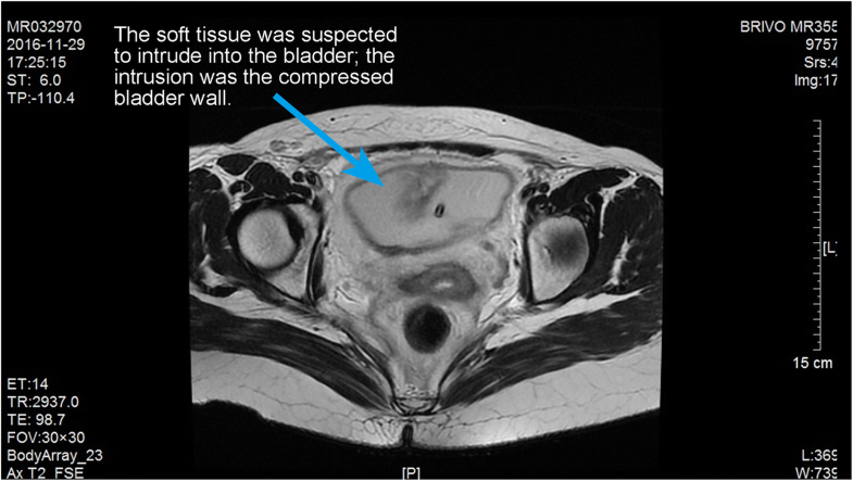 Delayed diagnosis of spontaneous bladder rupture: a rare case report ...