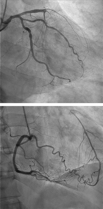Reduced coronary collateralization in type 2 diabetic patients with ...
