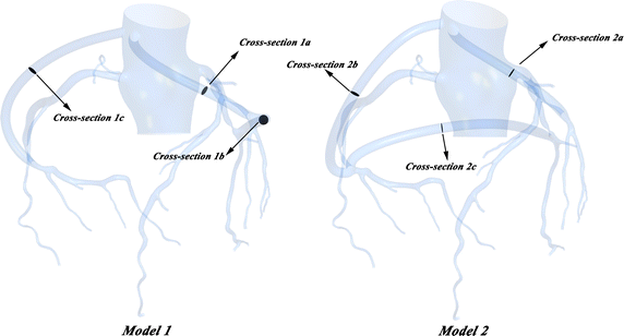 Hemodynamic analysis of sequential graft from right coronary system to ...