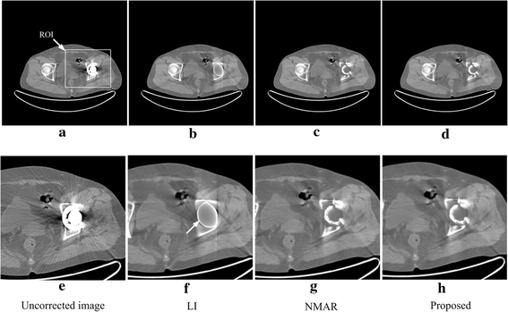 Gaussian diffusion sinogram inpainting for X-ray CT metal artifact ...