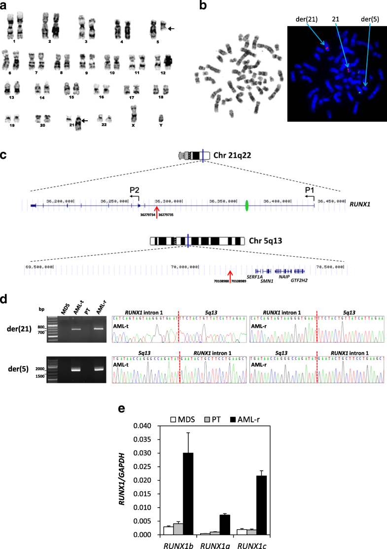 RUNX1 upregulation via disruption of long-range transcriptional control by a novel t(5;21)(q13 ...