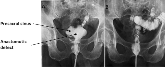 The over-the-scope clipping system for treatment of chronic coloenteric ...