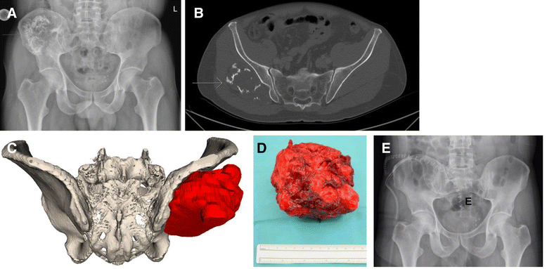 Tumor resection at the pelvis using three-dimensional planning and ...