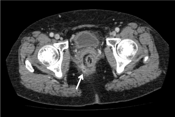 Delayed anastomotic leakage following laparoscopic intersphincteric ...