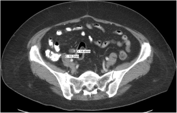 Low-grade appendiceal mucinous neoplasm and endometriosis of the ...