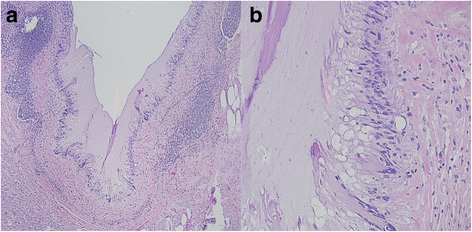 Low-grade appendiceal mucinous neoplasm and endometriosis of the ...