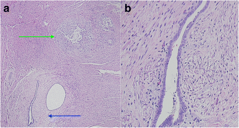 Low-grade appendiceal mucinous neoplasm and endometriosis of the ...