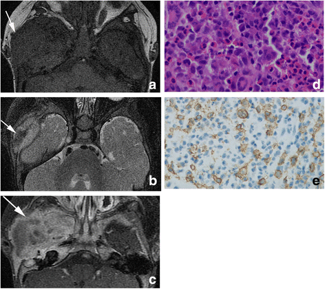 Pediatric Langerhans cell histiocytosis of the temporal bone: clinical ...