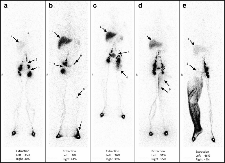 Use of lymphoscintigraphy to differentiate primary versus secondary ...