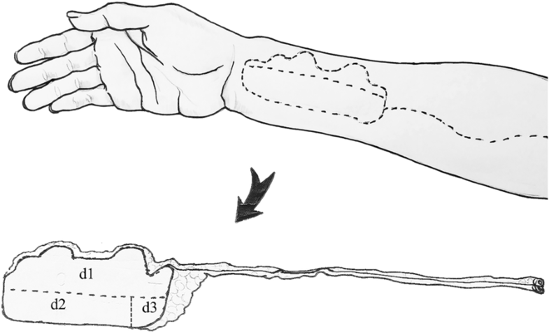 Reconstruction of a subtotal upper lip defect with a facial artery ...
