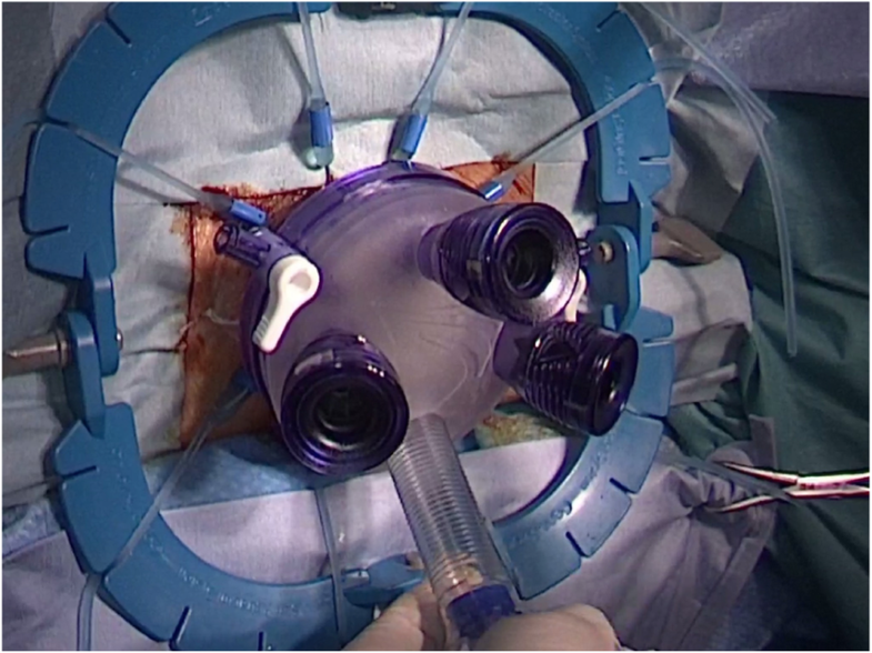 Radial incision and cutting method using a transanal approach for ...