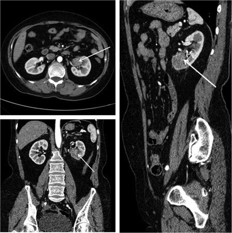 Total laparoscopic nephroureterectomy for upper urinary tract ...