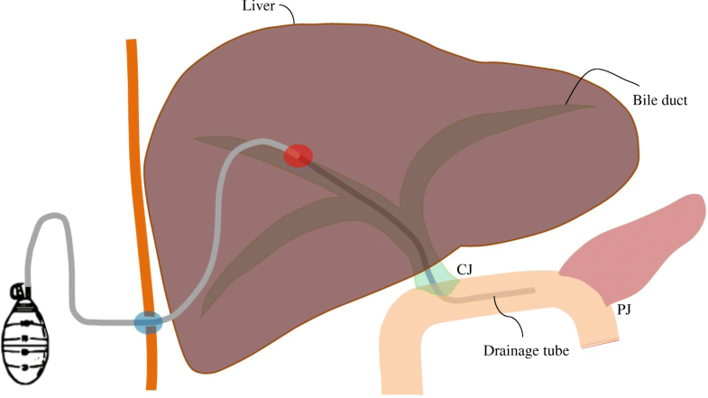 Retrograde installation of percutaneous transhepatic negative-pressure ...