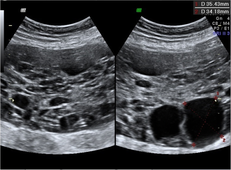 Recurrent maternal virilization during pregnancy in patients with PCOS ...