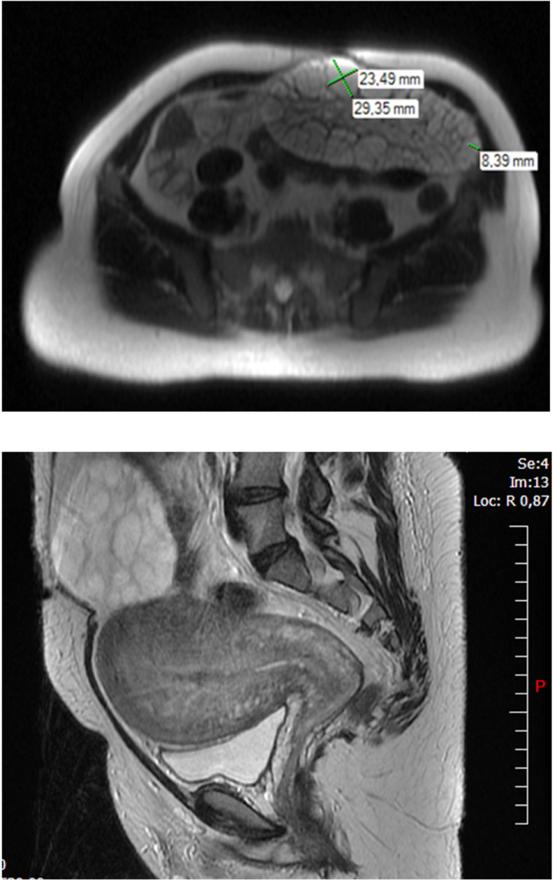 Recurrent maternal virilization during pregnancy in patients with PCOS ...