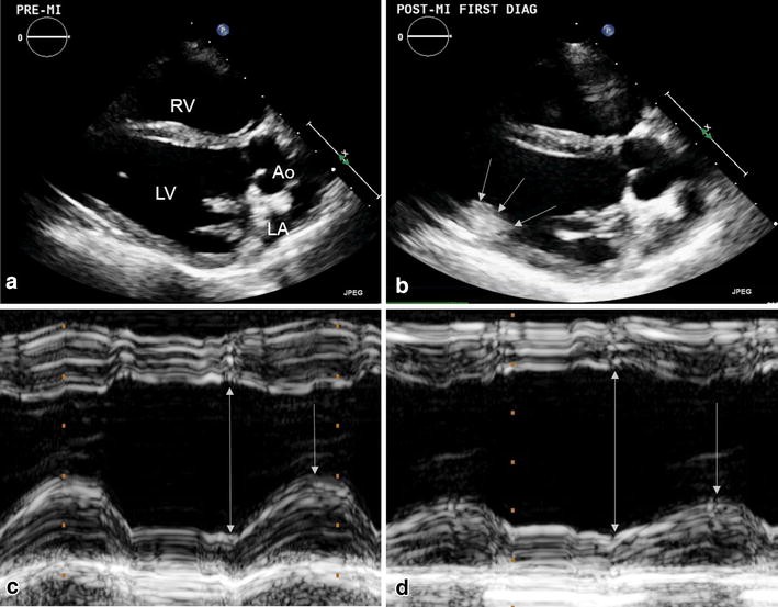 Embolization of the first diagonal branch of the left anterior ...