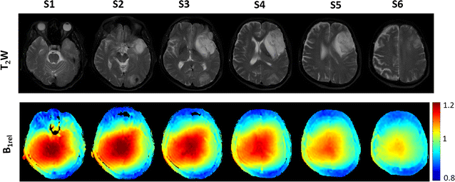 Evaluation of B1 inhomogeneity effect on DCE-MRI data analysis of brain tumor patients at 3T ...