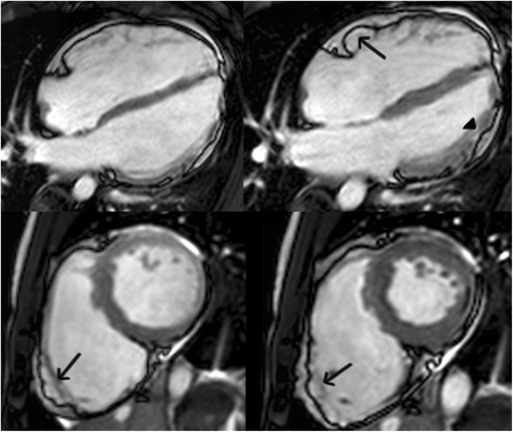 Arrhythmogenic right ventricular cardiomyopathy (ARVC): cardiovascular ...