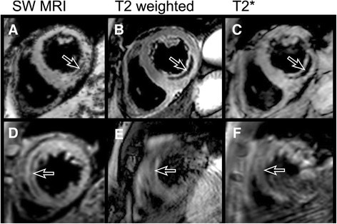 Susceptibility-weighted cardiovascular magnetic resonance in comparison ...