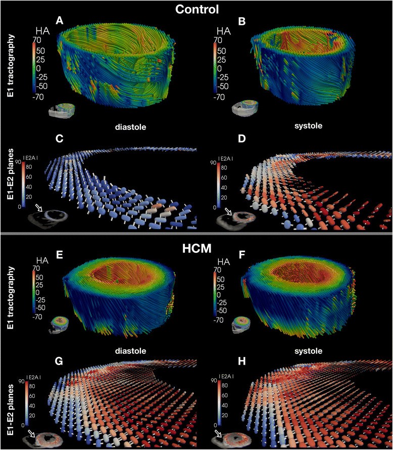In vivo cardiovascular magnetic resonance diffusion tensor imaging ...