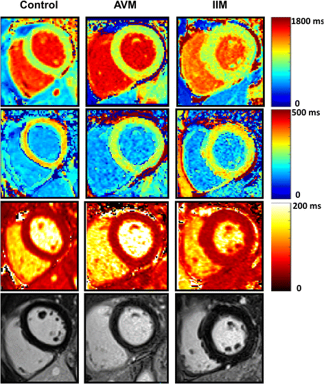 Non-invasive differentiation of idiopathic inflammatory myopathy with cardiac involvement from ...