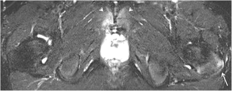 Diagnositic value of pelvic enthesitis on MRI of the sacroiliac joints ...