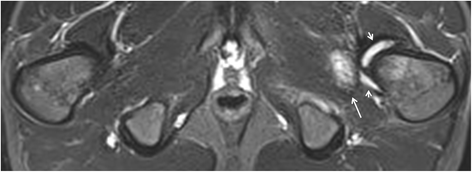 Diagnositic value of pelvic enthesitis on MRI of the sacroiliac joints ...