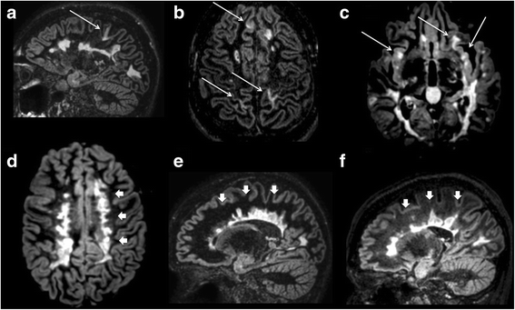 Increased cortical lesion load and intrathecal inflammation is associated with oligoclonal bands ...