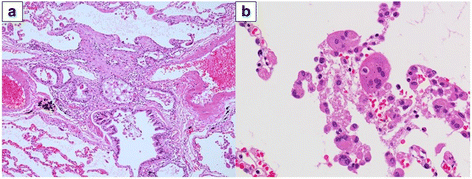 Two cases of hard metal lung disease showing gradual improvement in ...