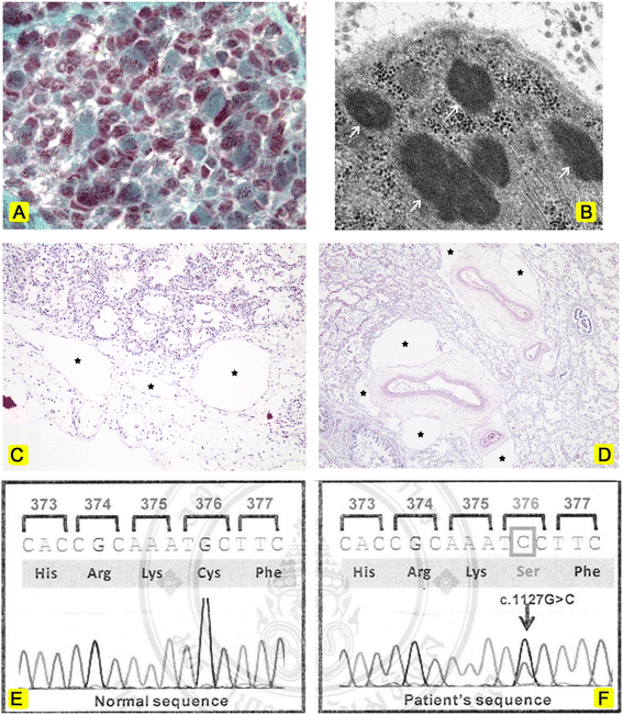 Severe congenital nemaline myopathy with primary pulmonary ...