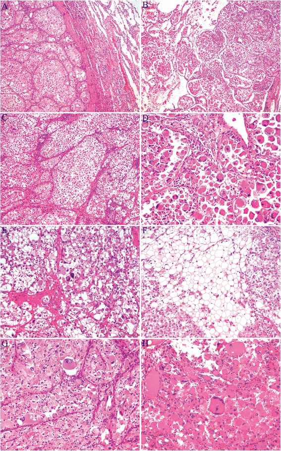 Alveolar soft part sarcoma of lung: report of a unique case with ...