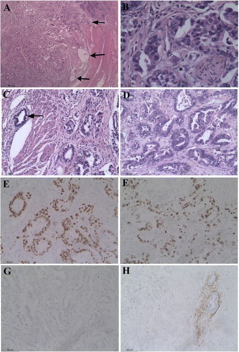 Serous carcinoma arising from uterine adenomyosis/adenomyotic cyst of ...