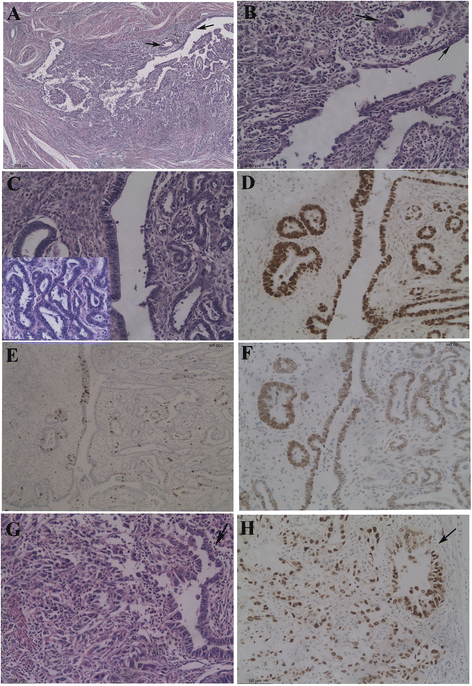Serous carcinoma arising from uterine adenomyosis/adenomyotic cyst of ...