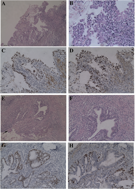 Serous carcinoma arising from uterine adenomyosis/adenomyotic cyst of ...