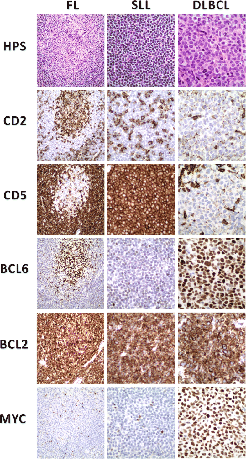 High-grade B-cell lymphoma with MYC and BCL2 rearrangements arising in a composite lymphoma ...