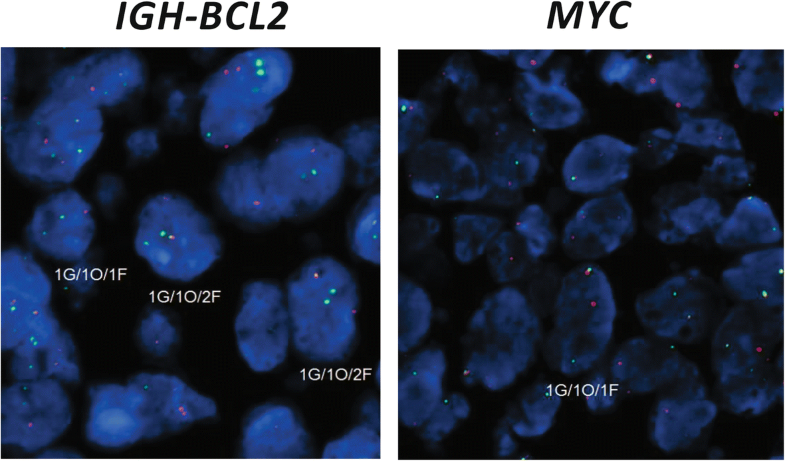 High-grade B-cell lymphoma with MYC and BCL2 rearrangements arising in a composite lymphoma ...