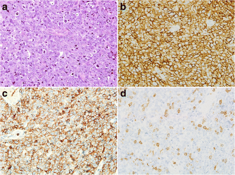 Pure intravascular recurrence of CD5-positive diffuse large B-cell ...