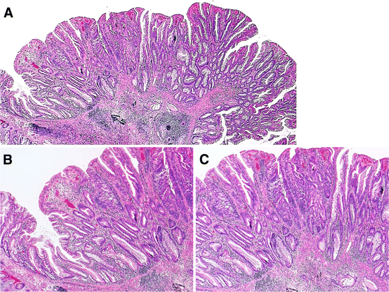 Molecular characterization of sessile serrated adenoma/polyps with ...