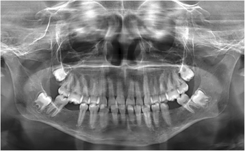 CANDLE SYNDROME: Orofacial manifestations and dental implications ...