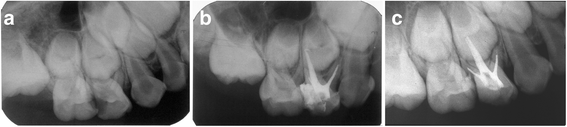 Clinical and radiographic evaluation of pulpectomy in primary teeth: a ...