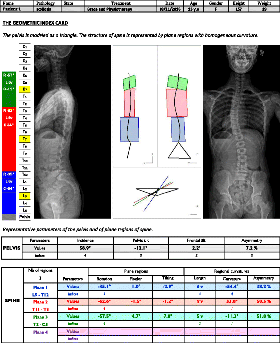 Three-dimensional reconstructions of Lenke 1A curves | Scoliosis and ...