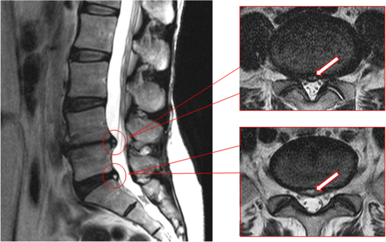 The association of high-intensity zones on MRI and low back pain: a ...