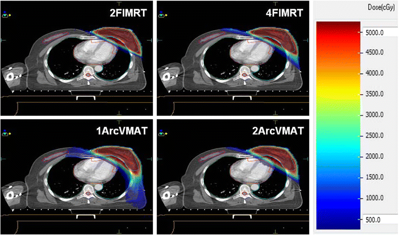 A comparative dosimetric study of left sided breast cancer after breast ...