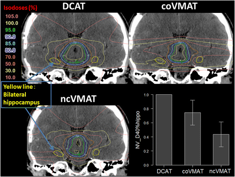 Non-coplanar volumetric-modulated arc therapy (VMAT) for ...