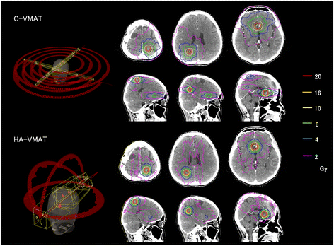 HyperArc VMAT planning for single and multiple brain metastases stereotactic radiosurgery: a new ...
